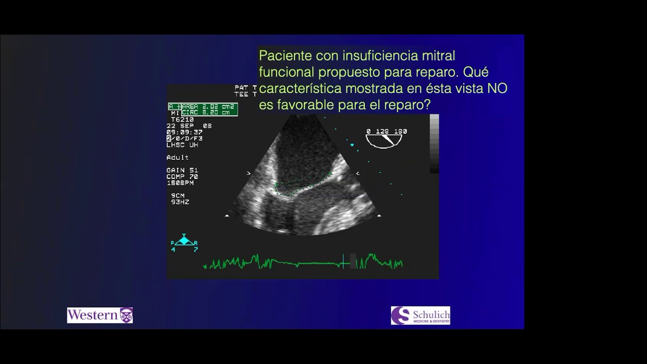 Ecografía De La Anatomía De La Válvula Mitral El Ecocardiograma