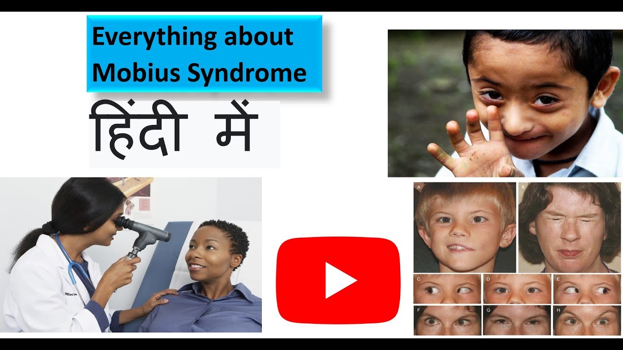 Everything about Mobius Syndrome including Causes, Diagnosis and ...