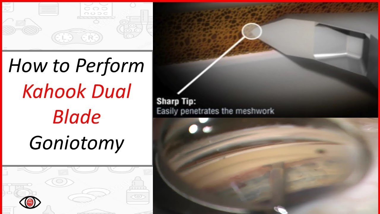 How to Perform Kahook Dual Blade (Goniotomy) Micro Invasive Glaucoma ...