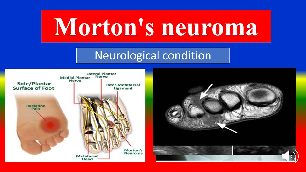 MORTON'S NEUROMA - Definition, types, causes, pathophysiology, symptoms ...