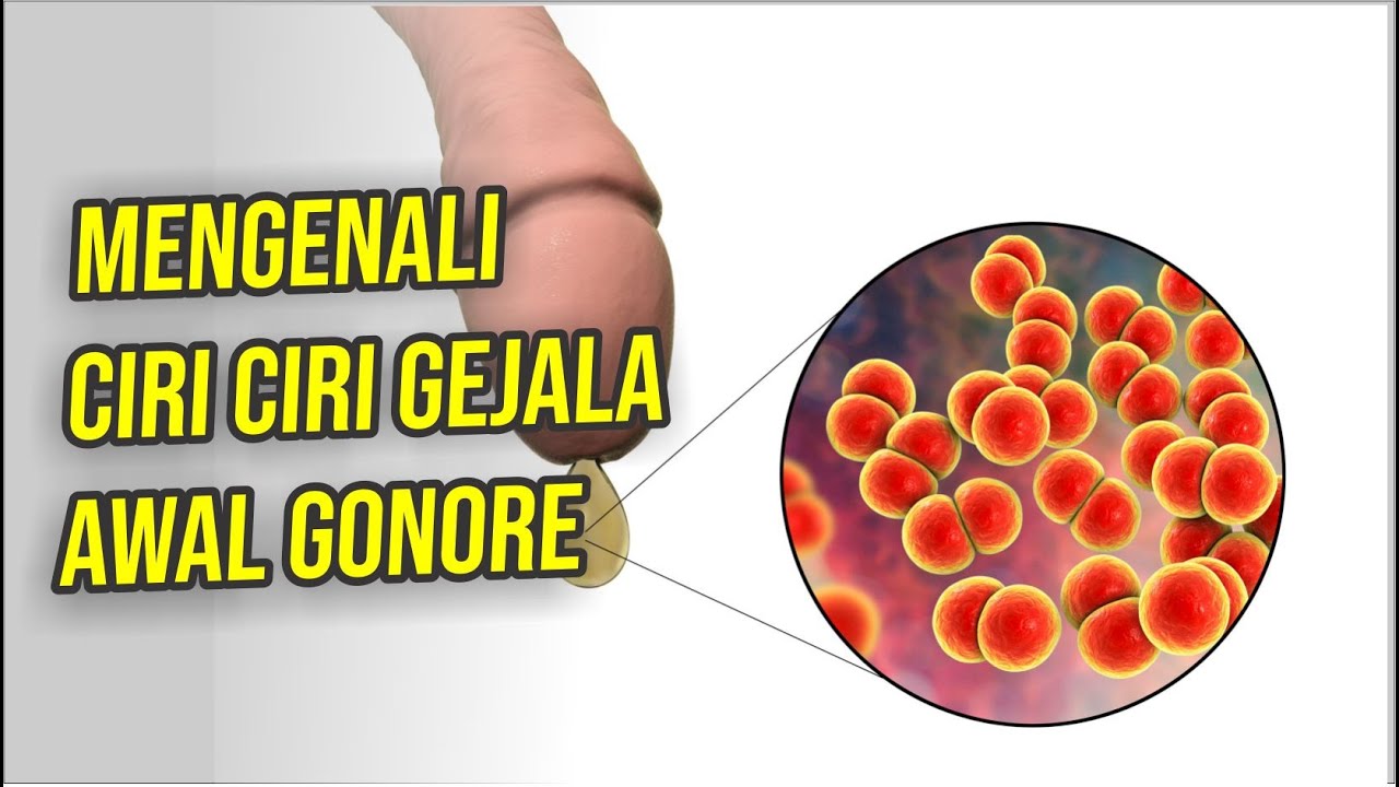 Mengenali Ciri Ciri Gejala Awal Gonore - Konsultasi Penyakit Kelamin ...