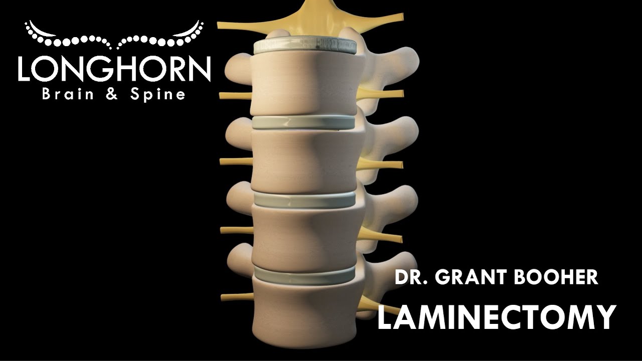 Longhorn Brain and Spine - Laminectomy - YouTube