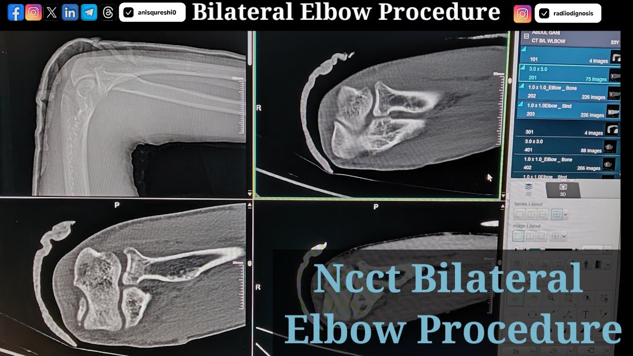 Bilateral Elbow CT Scan | By Anis Qureshi - YouTube