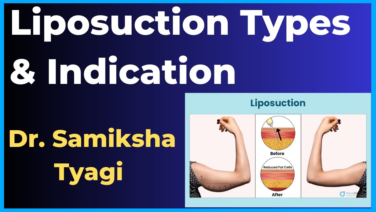 4 Types of Liposuction / Best Liposuction Surgeon Noida / Delhi NCR ...