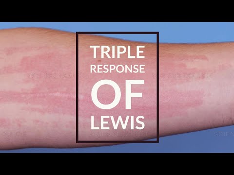 Triple Response of Lewis | Physiology Review - 200 MCQ , 2016 - YouTube