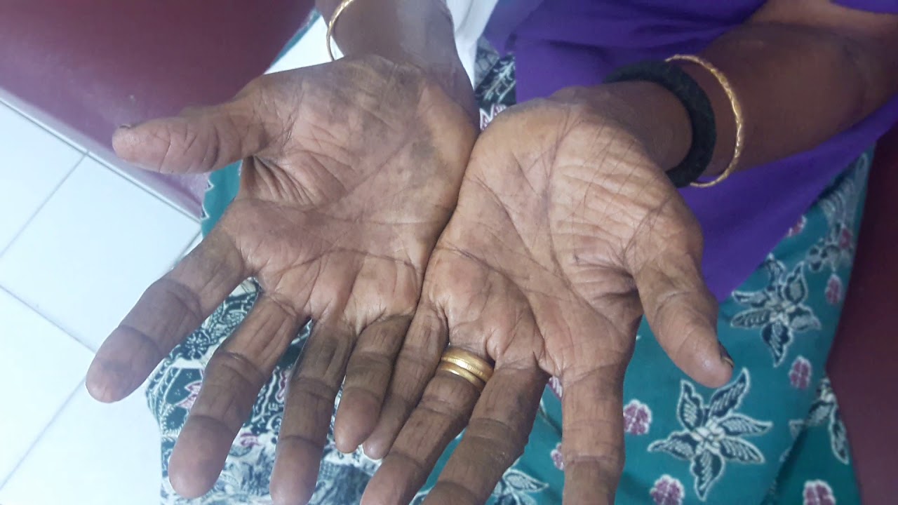 Palms post inflammatory hyperpigmentation - YouTube