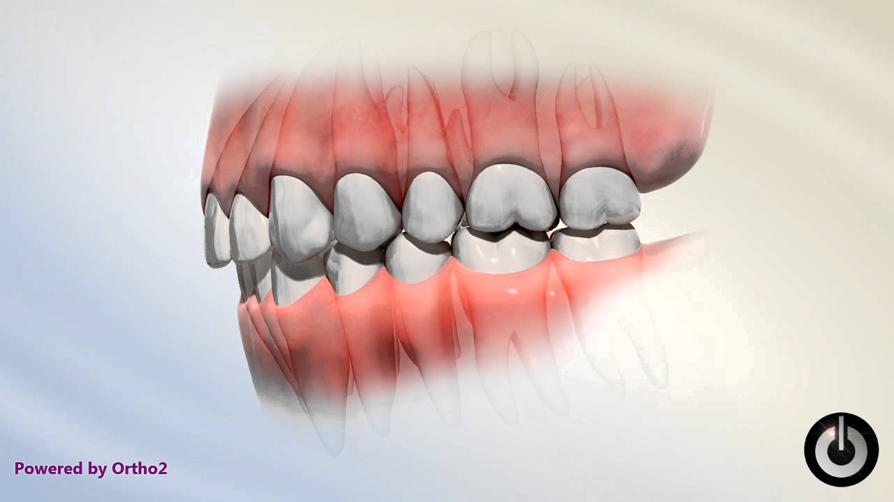 Class II End On - YouTube