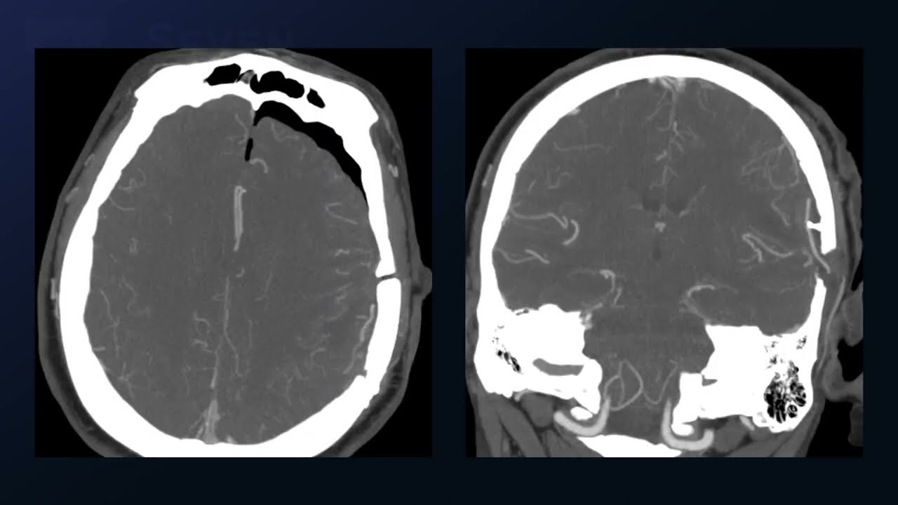 Trapping of Mycotic MCA Aneurysm with Combination Bypass (STA-MCA ...