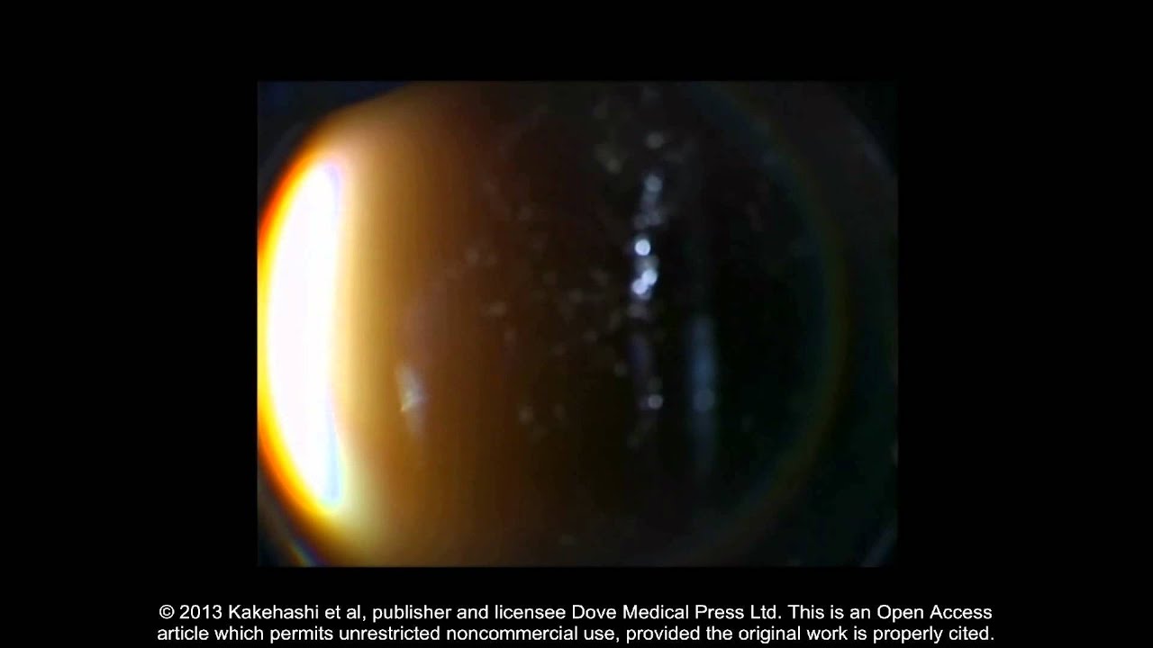 Posterior Vitreous Detachment Slit Lamp Spontaneous Posterior Vitreous