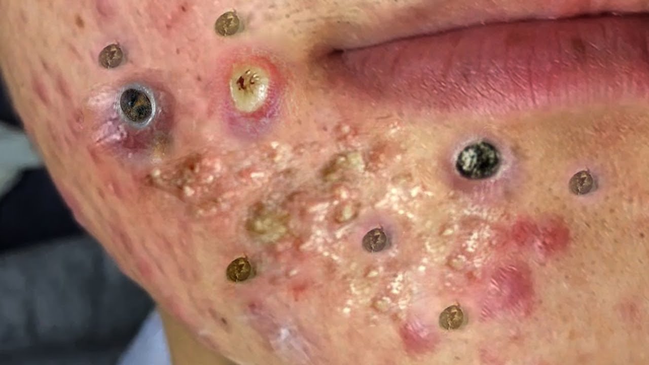 𝐌𝐨𝐬𝐭 𝐒𝐚𝐭𝐢𝐬𝐟𝐲𝐢𝐧𝐠 𝐏𝐢𝐦𝐩𝐥𝐞𝐬 𝐑𝐞𝐦𝐨𝐯𝐚𝐥 𝐀𝐭 𝐇𝐨𝐦𝐞 #1413 - YouTube