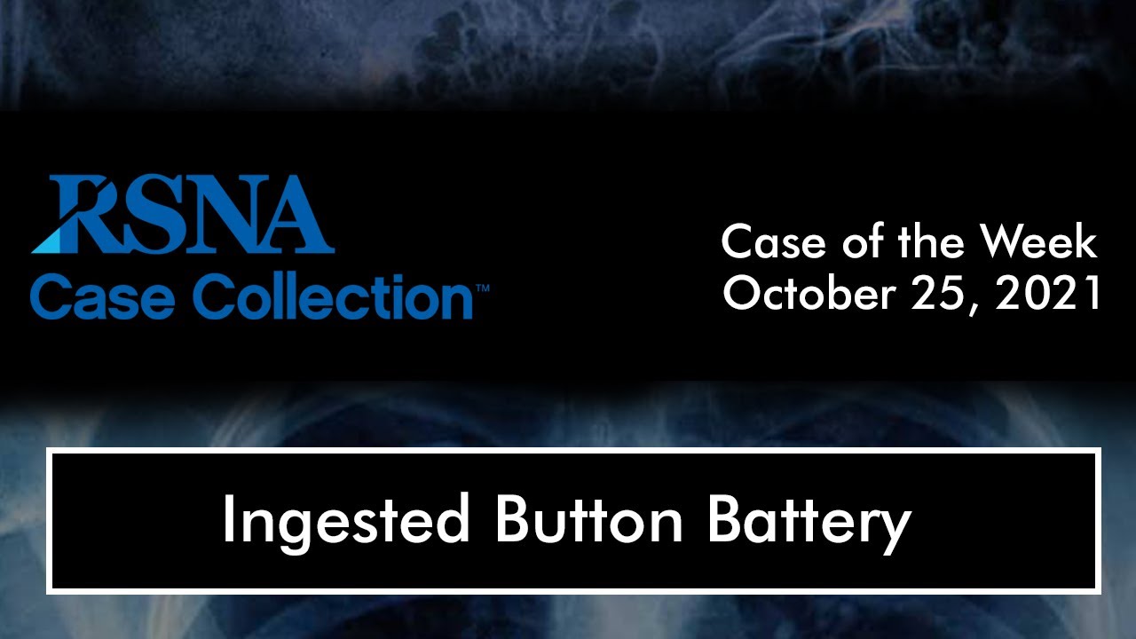 Case of the Week: Ingested Button Battery - YouTube