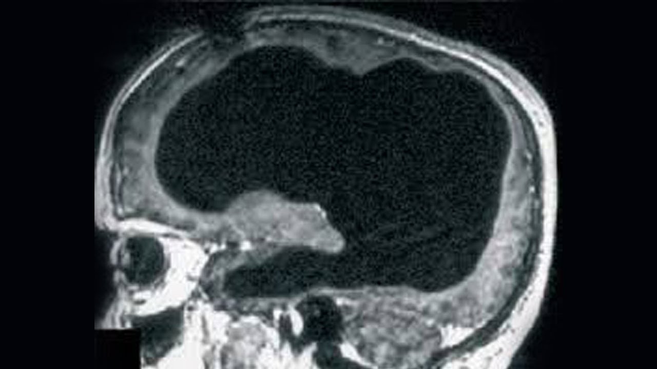 The Man With 10% of a Brain - YouTube