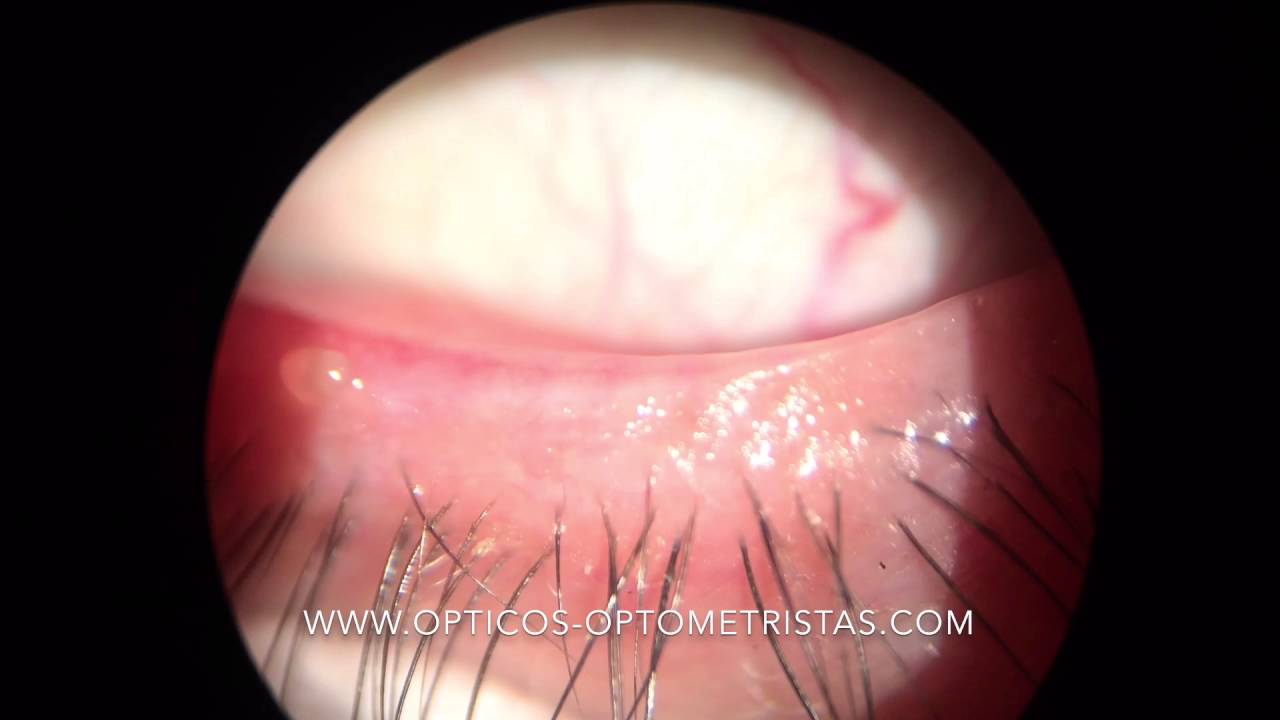 Glándula de Meibomio obstruida - YouTube