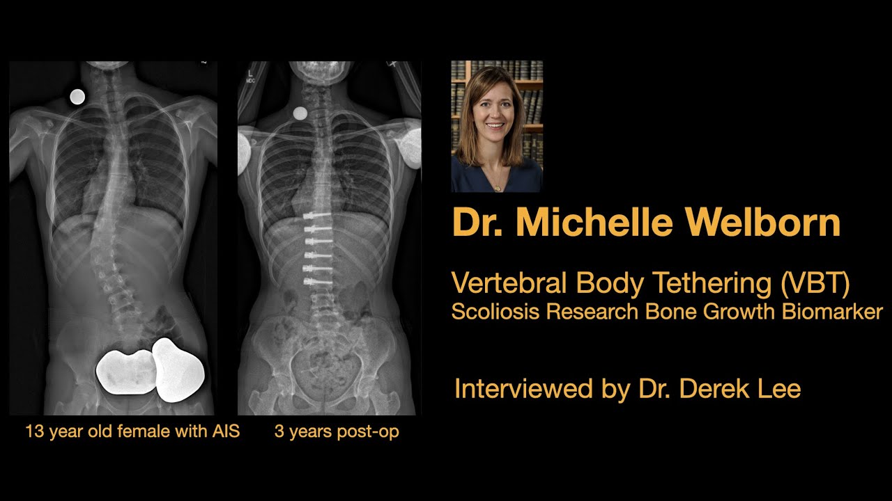 Dr. Michelle Welborn, Vertebral Body Tethering & Research on Growth ...