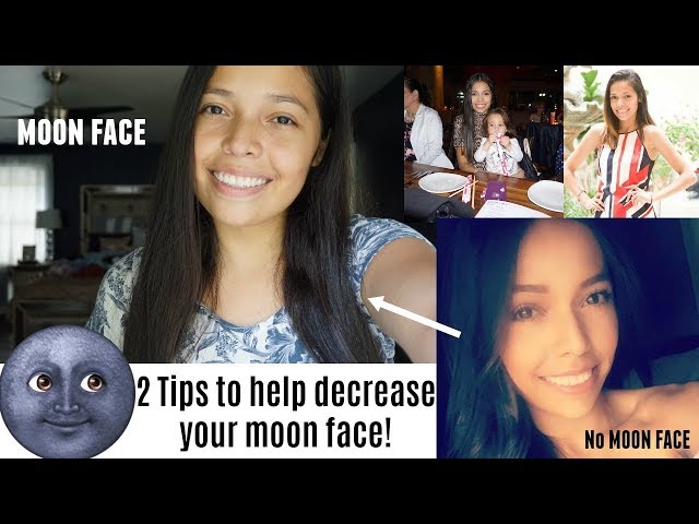 Prednisone Moon Face