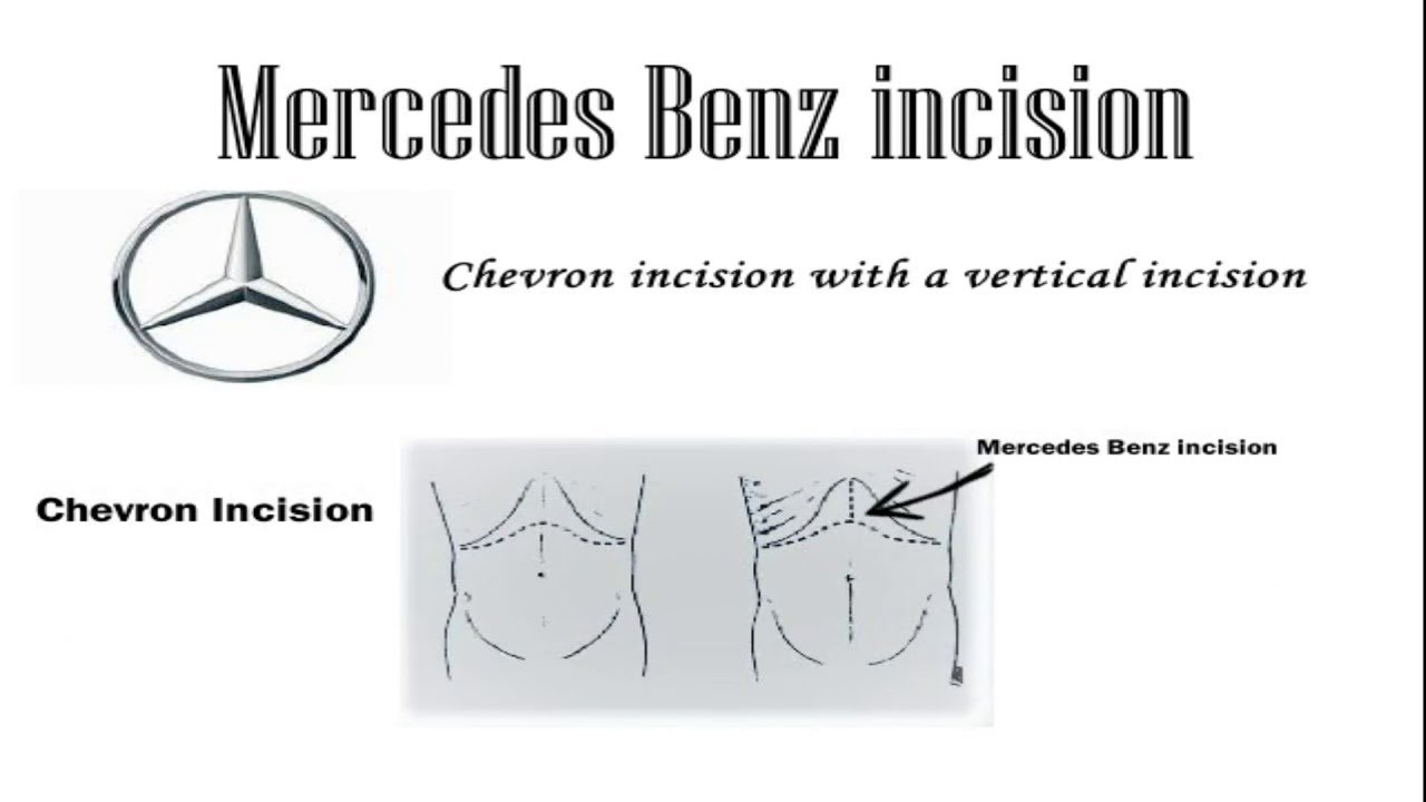 Chevron & Mercedes Benz incision - YouTube