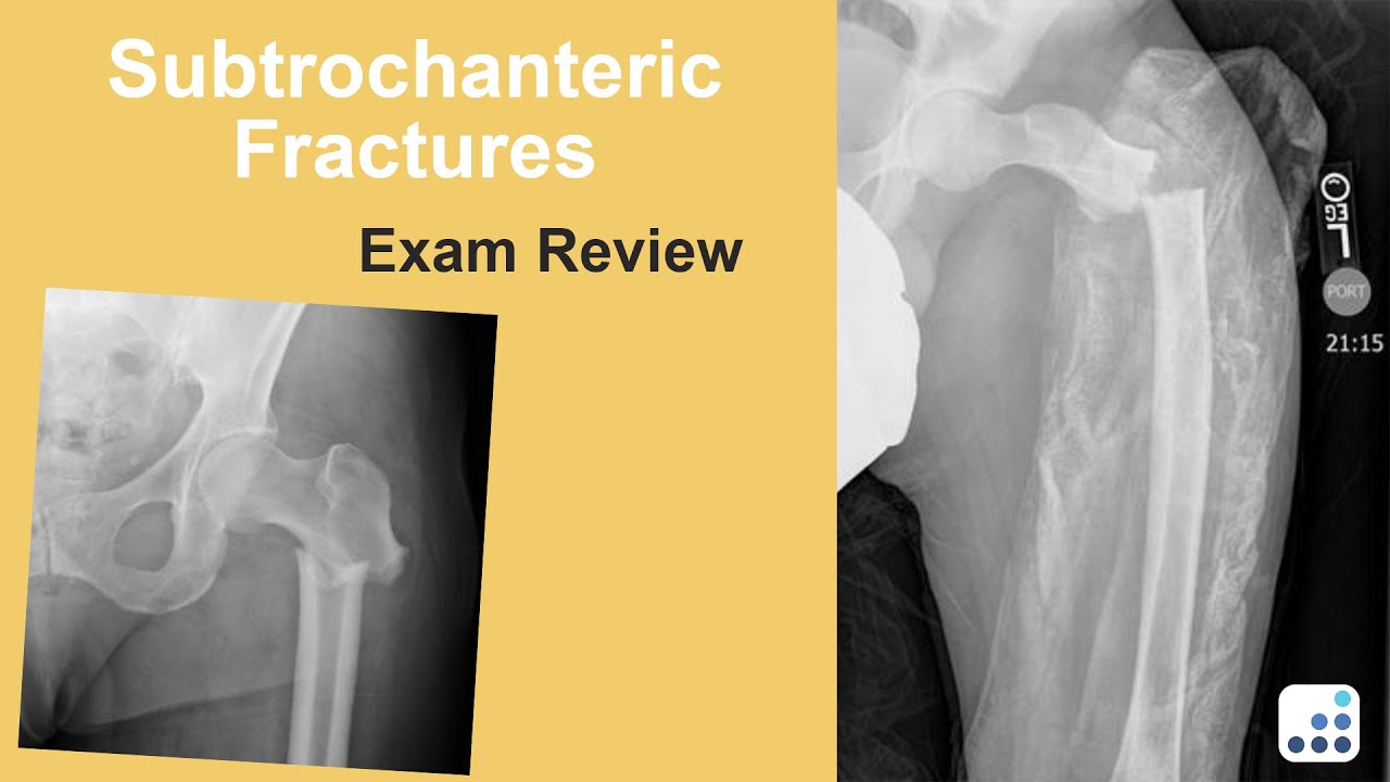 Subtrochanteric Fractures Exam Review - Bohannon Mason, MD - YouTube