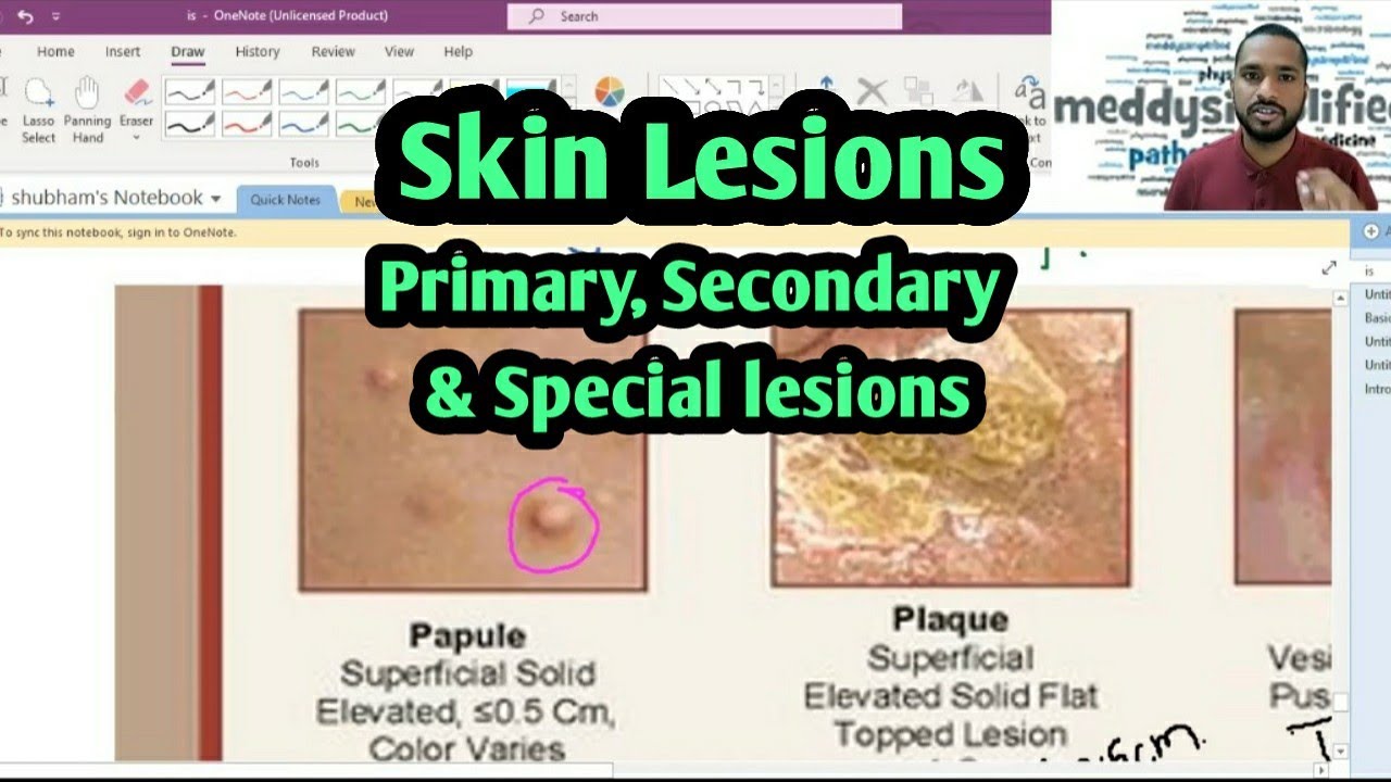 Skin lesions | Primary and Secondary Skin lesions |Target lesion ...