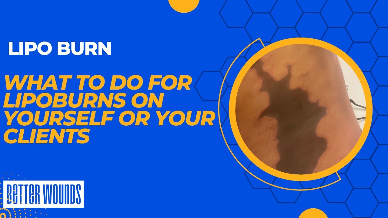 Recovery after liposuction: What to do with lipoburn - YouTube