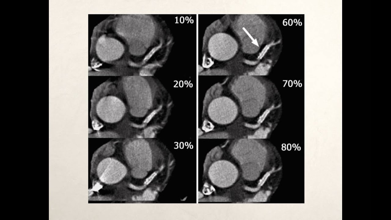 CTCAG (CT Coronary Angiography) Part-1 - YouTube