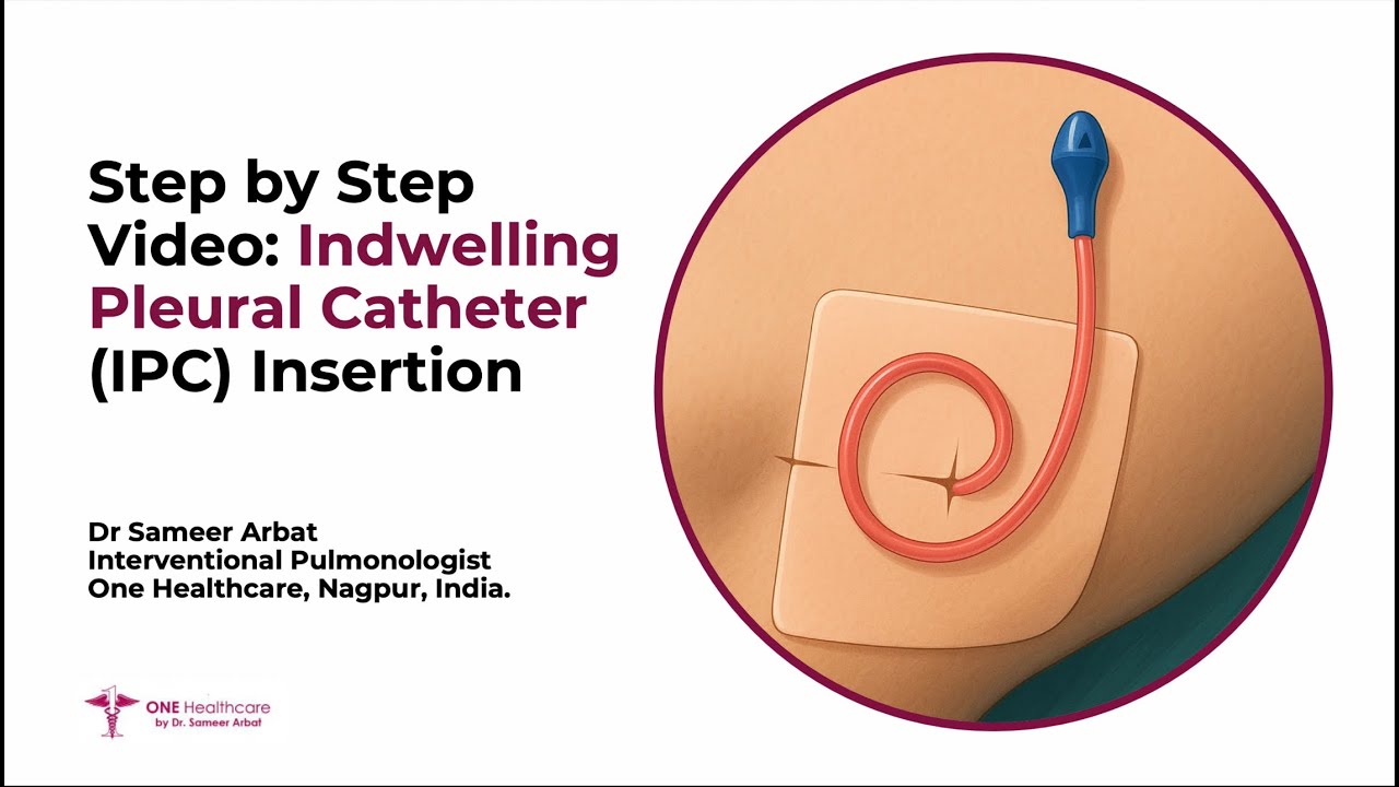 Indwelling Pleural Catheter (IPC) Insertion Video: Step-by-step Guide @DrSameerArbat - YouTube