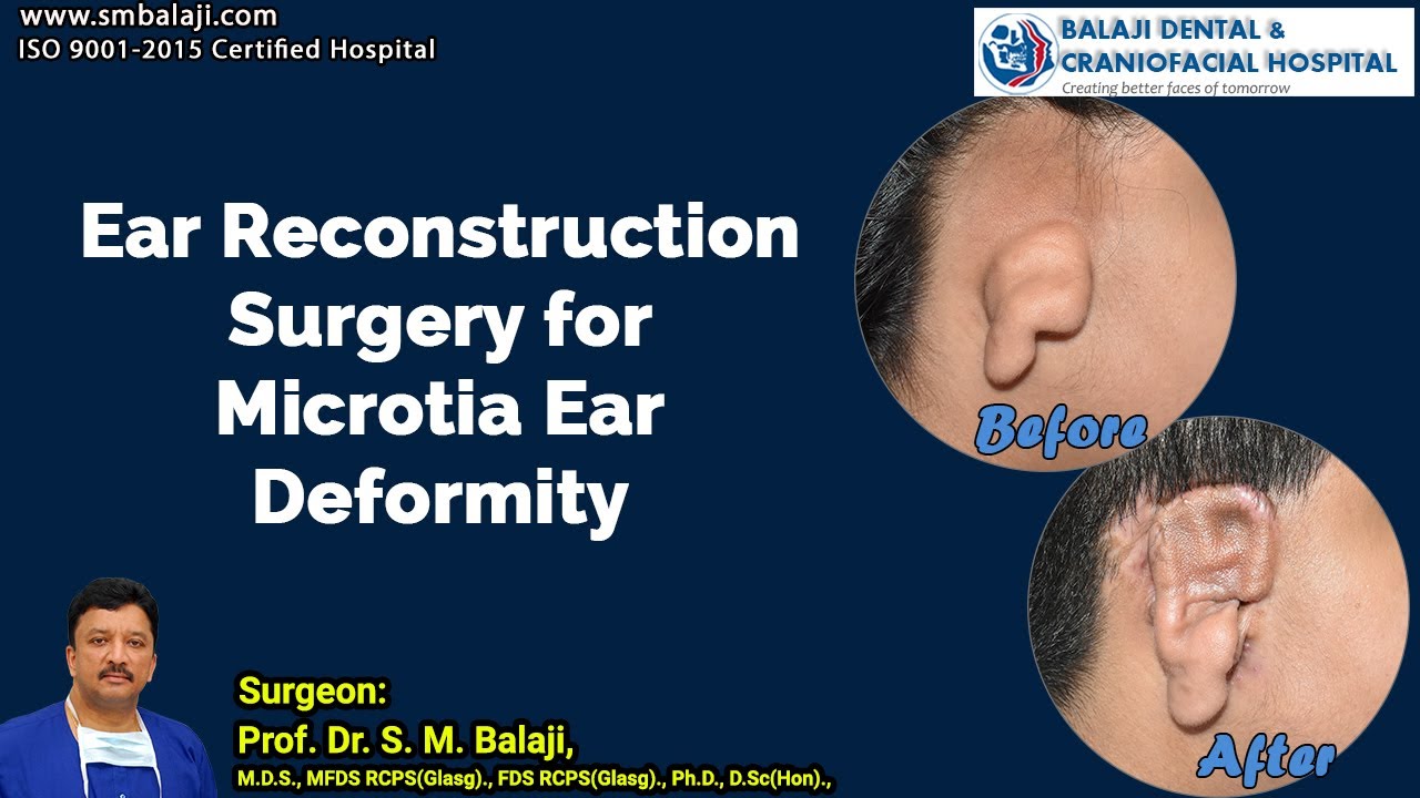 Ear Reconstruction Surgery for Microtia Ear Deformity - YouTube
