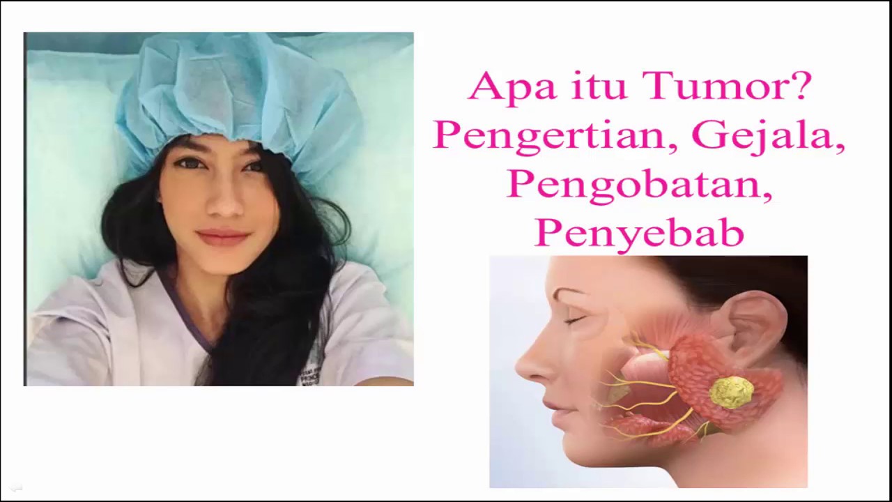 Apa itu Tumor? Pengertian, Penyebab, Pengobatan Tumor - YouTube