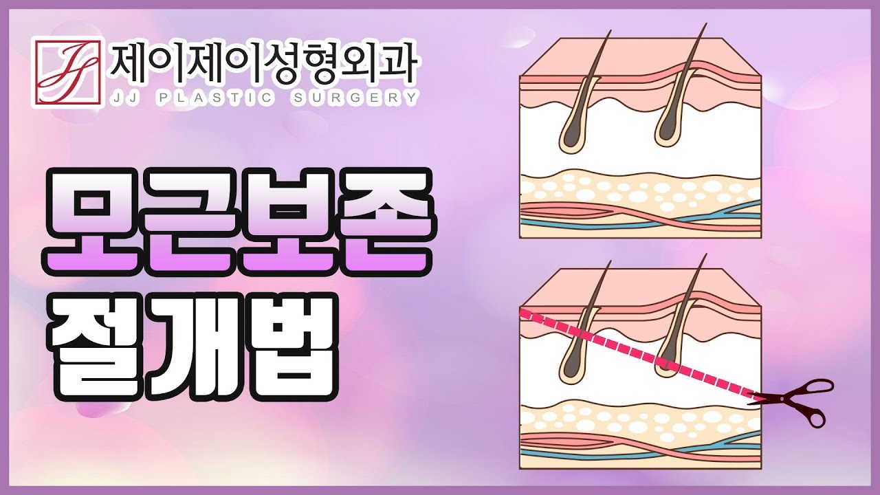 모근보존 절개법 Transfollicular incision,Trichophytic incision - YouTube