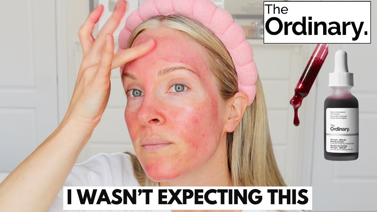 TRYING THE ORDINARY PEELING SOLUTION FOR THE FIRST TIME IN 6 YEARS ...