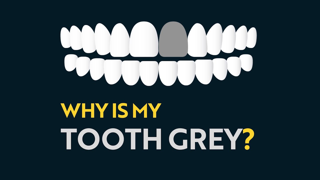 Why is My Tooth Grey? - YouTube