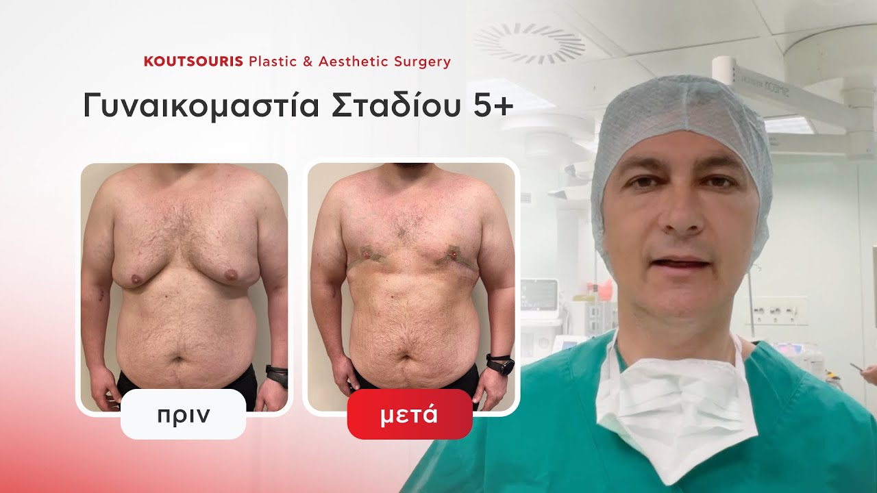 Γυναικομαστία Βαθμού 5+ Eπέμβαση σε ασθενή 32 ετών - YouTube