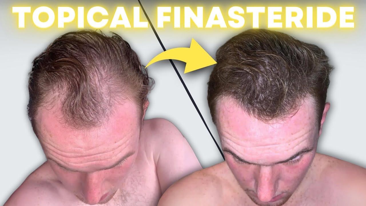 Topical Finasteride: Reversing Hair Loss without Side Effects! | AL ...