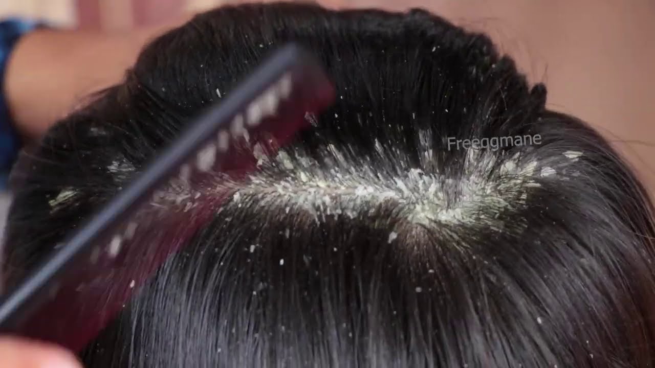 Psoriasis Scalp Removal Big Flakes - Dandruff Scratching Satisfying ...