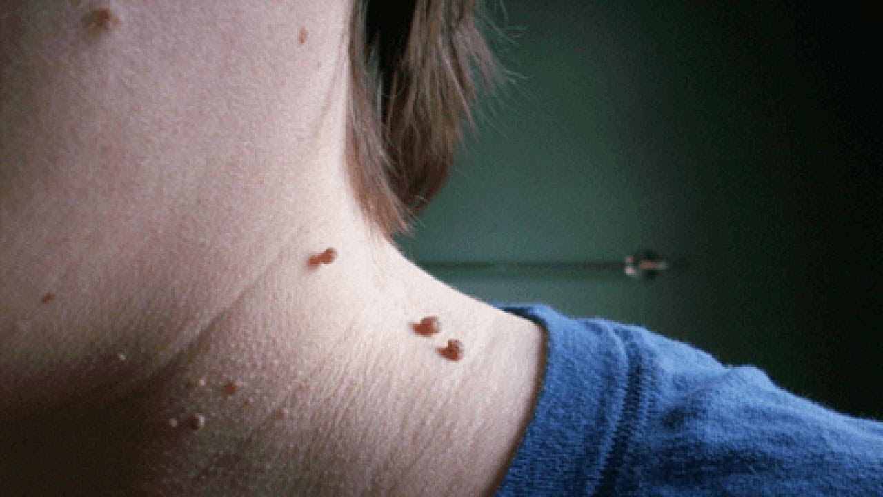 Naturlige løsninger for hudormer, vorter og kviser - YouTube