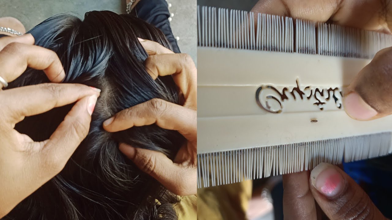 Routine Heavy Oiled Short Hair Nitpicking / Lice Picking at Home ...