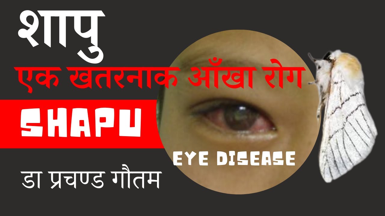 SHAPU Seasonal Hyper Acute Pan-Uveitis Eye Disease सेतो पुतली र शापु ...