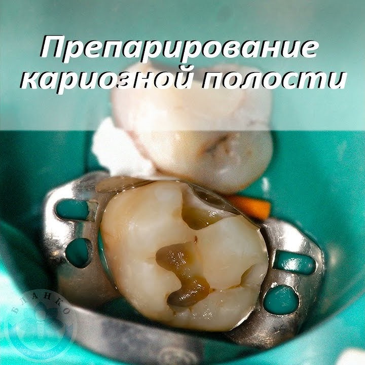 Пломба зуба, матрица, лечение кариеса зубов, реставрация зуба, пломба ...