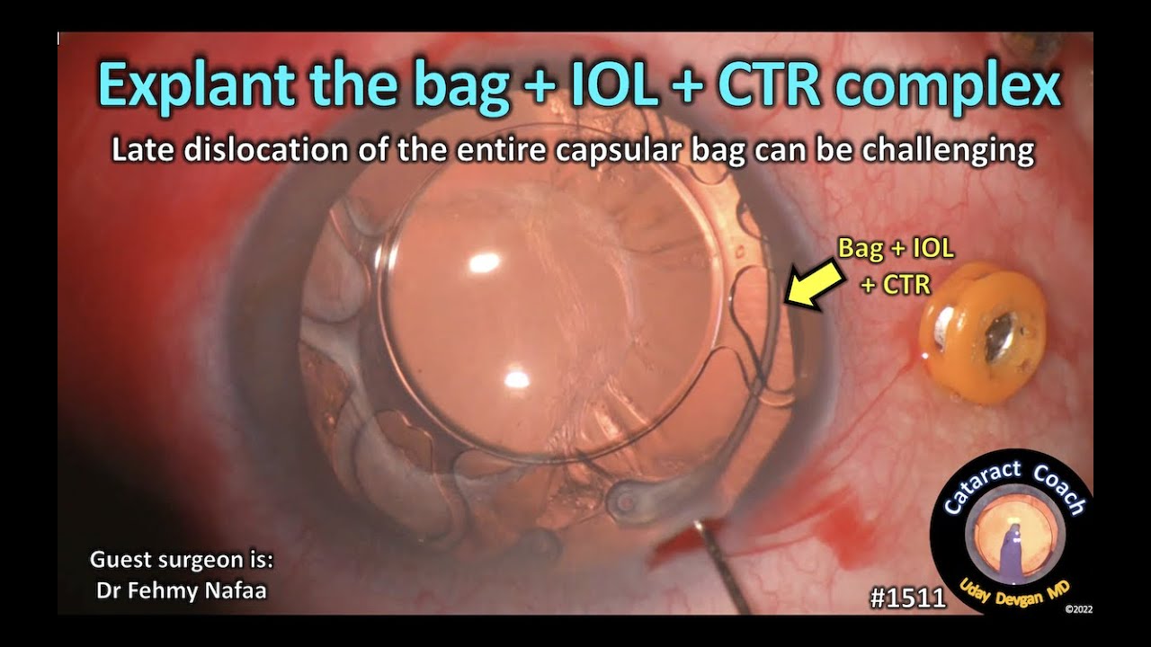 CataractCoach 1511: explant the bag + IOL + CTR complex - YouTube