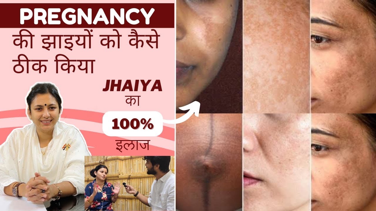 Pregnancy में हुई झाइयों को कैसे ठीक किया | Pigmentation Jhaiya Patient ...