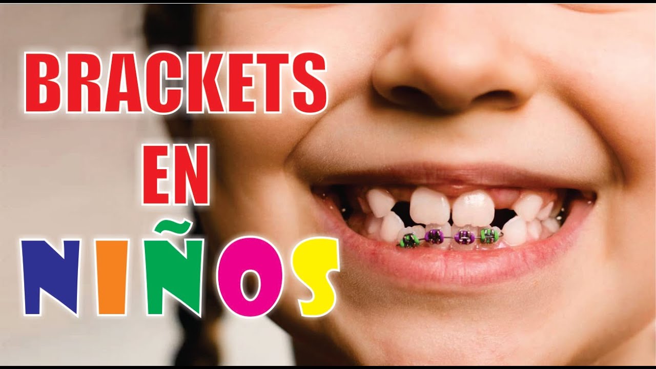 ¿BRACKETS para NIÑOS? 🦷 ORTODONCIA en la PRIMERA INFANCIA 👶 SANTIAGO ...