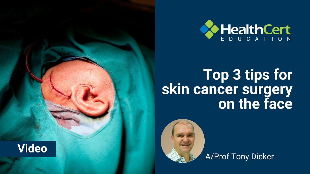 Top 3 tips for skin cancer surgery on the face | A/Prof Tony Dicker ...
