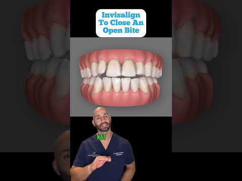 Can Invisalign Correct An Open Bite