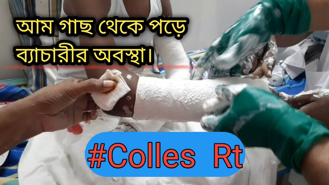 Long arm full plaster & colles plaster (fracture Lt. s/c & Rt colles ...