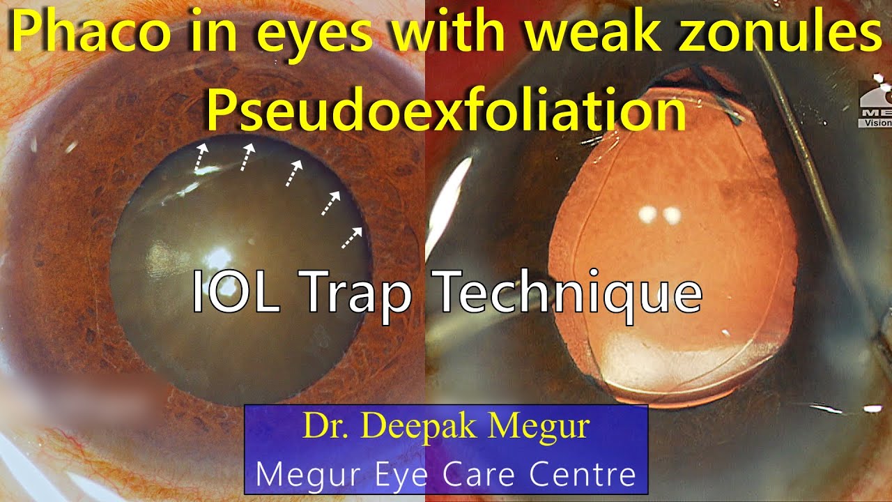 The IOL Trap technique in eyes with generalised zonular weakness due to ...