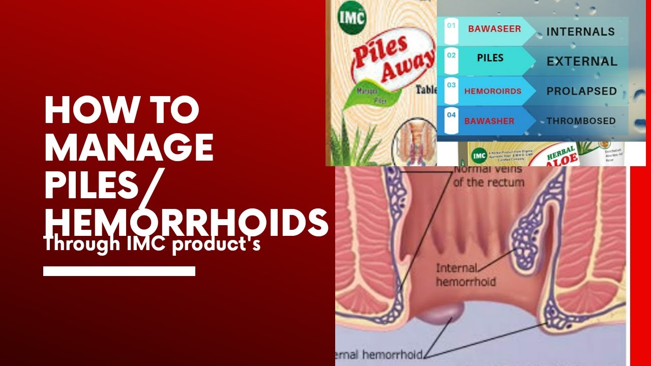 HOW TO MANAGE PILES THROUGH IMC /HOW TO CURE PILE AT HOME/HOME REMEDIES ...