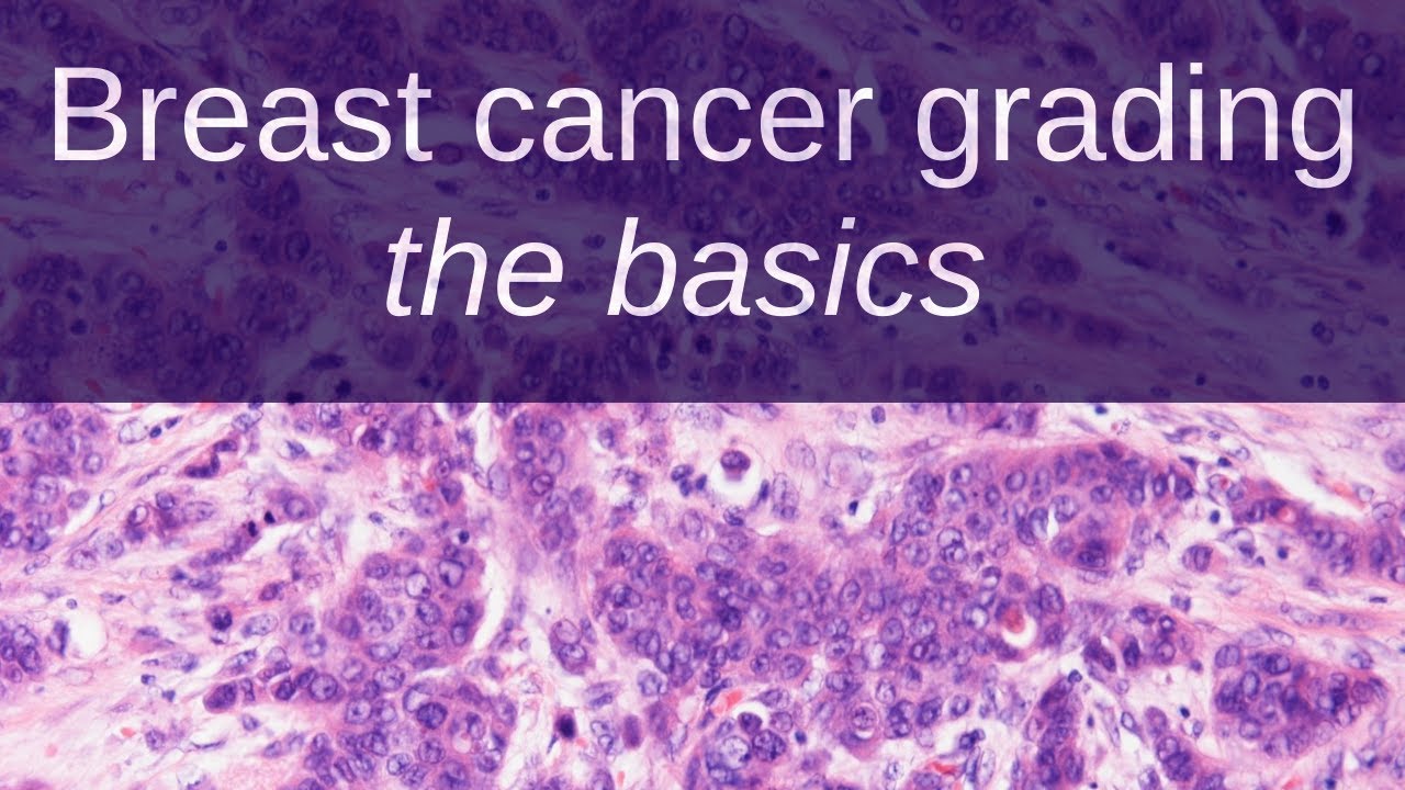 How to Grade Breast Cancer - The basics - YouTube