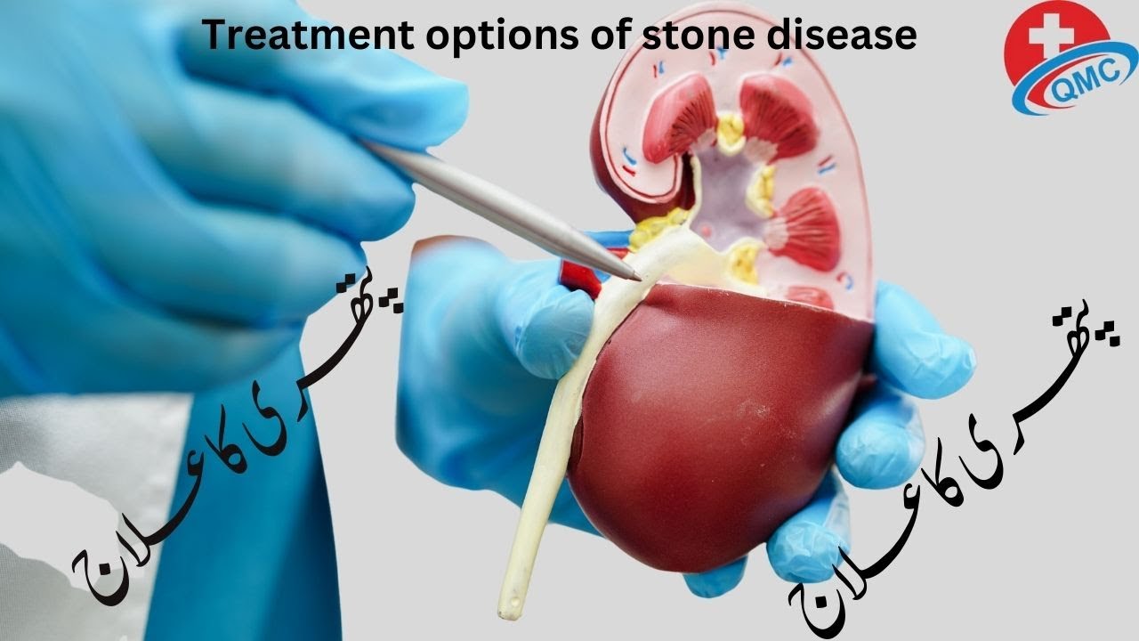 Treatment options of stone disease - YouTube
