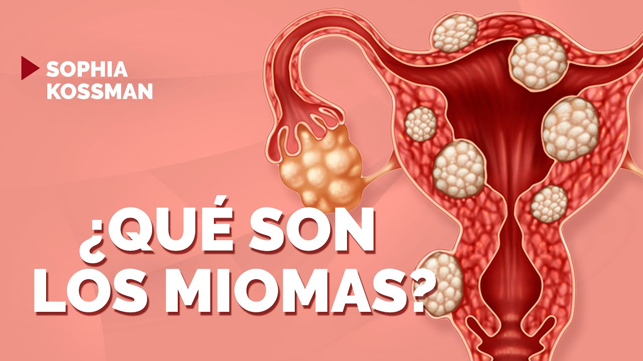¿Qué son los miomas? - Sophia Kossman 👩 - YouTube