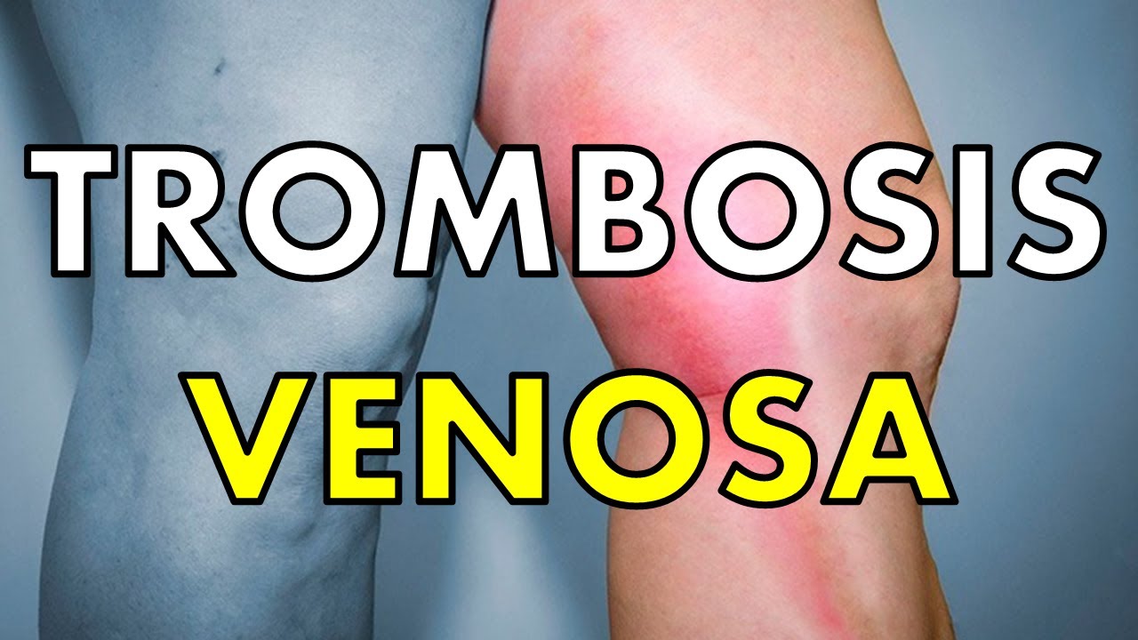 🔴 TROMBOSIS VENOSA PROFUNDA: SIGNOS Y SÍNTOMAS, CAUSAS, PREVENCIÓN Y ...