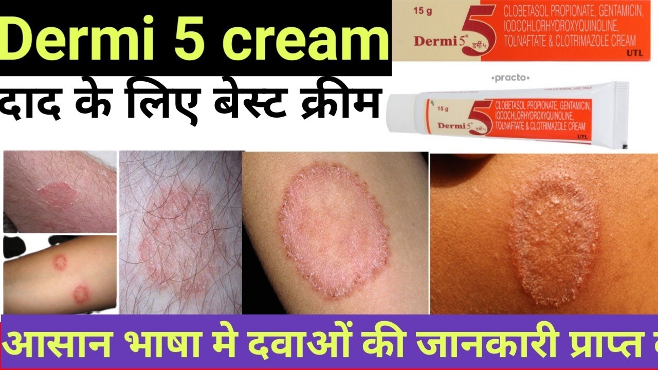 Dermi 5 Cream || Uses, Dose, And Side Effects, काली या लाल दाद से जल्द ...